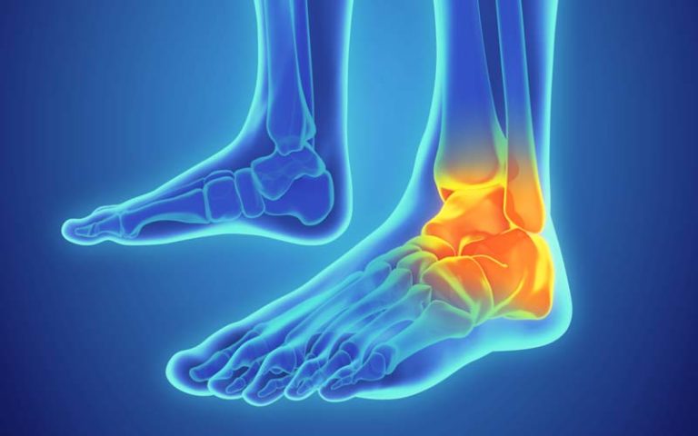 Grade 2 Ankle Sprain: Symptoms, Recovery Time & Fast Healing