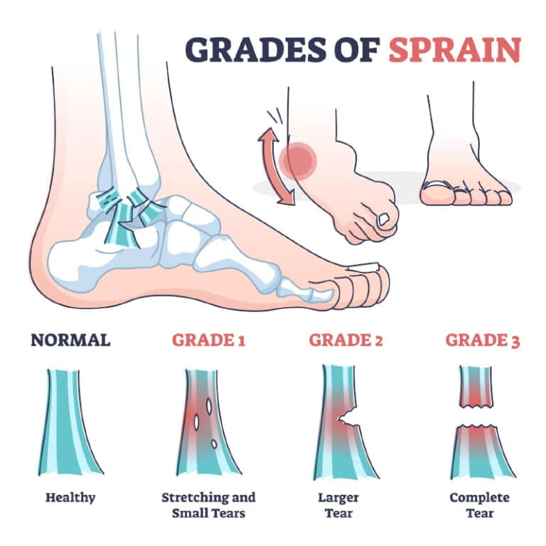 Sprained Ankle Grades: Understand Your Injury and Heal Fast