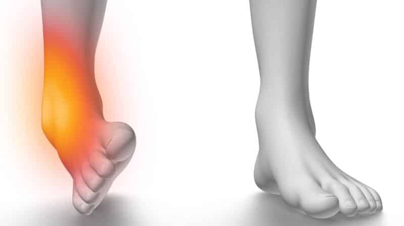 How to Heal an Ankle Twist Fast