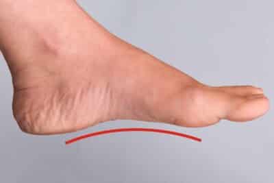 Understanding Fallen Arches: Causes, Symptoms, and Treatments