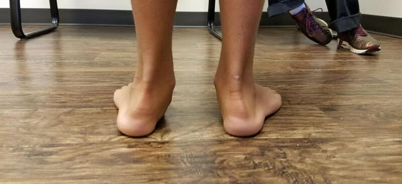 Pes Planus: Overview, Causes, Symptoms, and Treatment Options