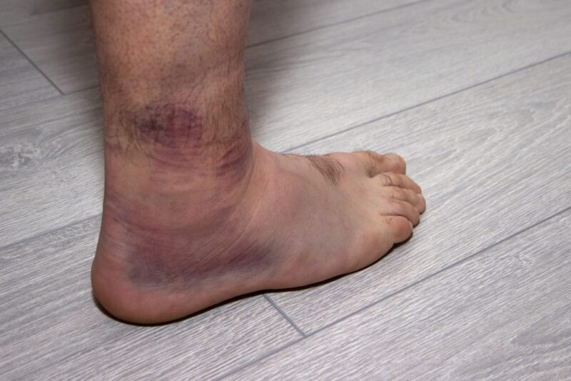 What is the best way to treat an ankle sprain?