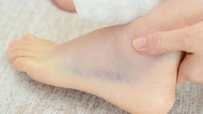 Should I walk on a sprained ankle?